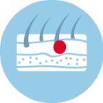 Sinus pilonidal o Quiste dermoide: qué es y su solución - Doctor ...